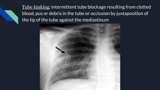 tubes on chest xrays | PPTX