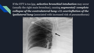 tubes on chest xrays | PPTX