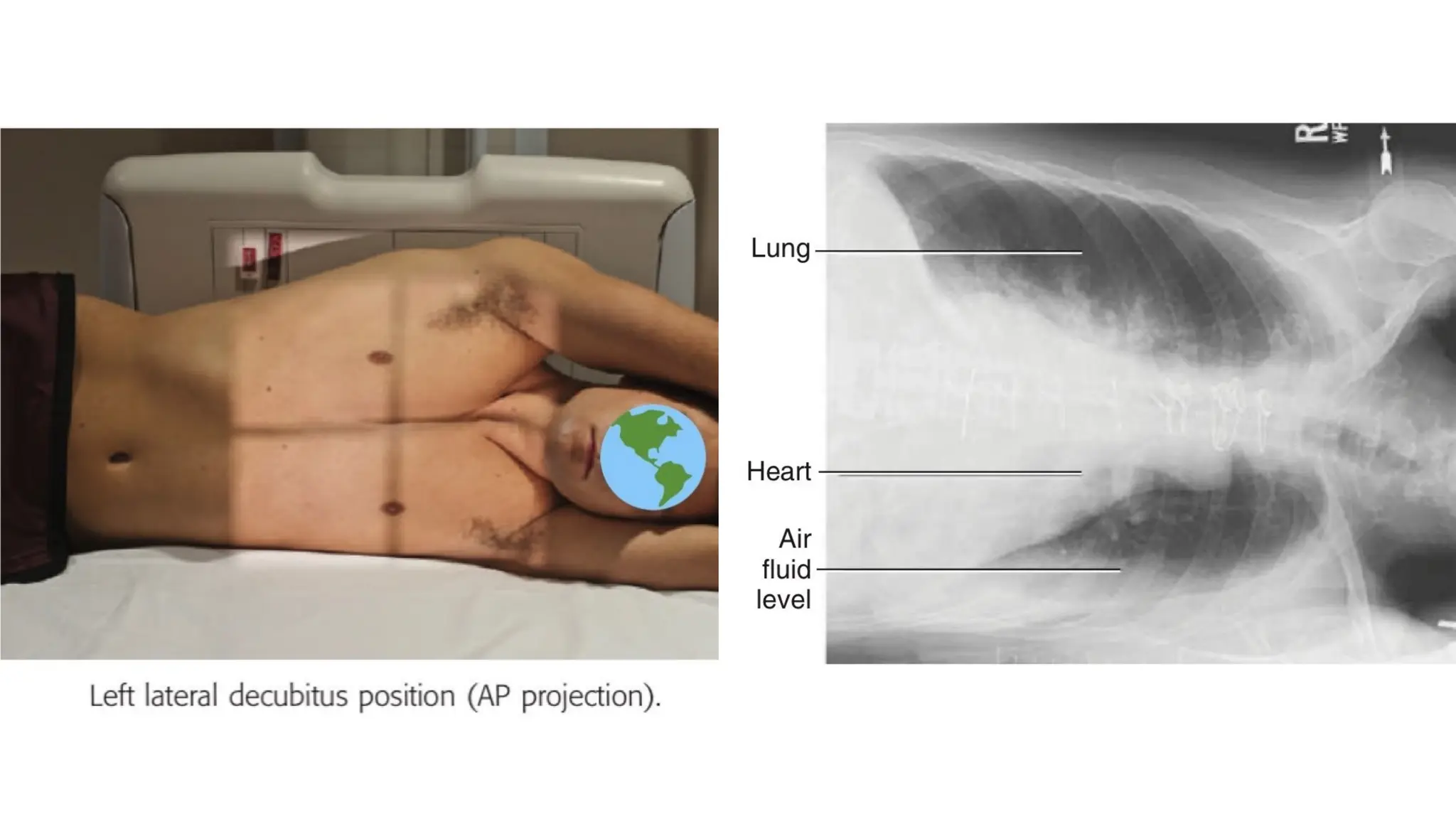 Chest X-Ray (CXR) Interpretation Made Easy: A Comprehensive Guide to Common Chest Pathologies | PPTX