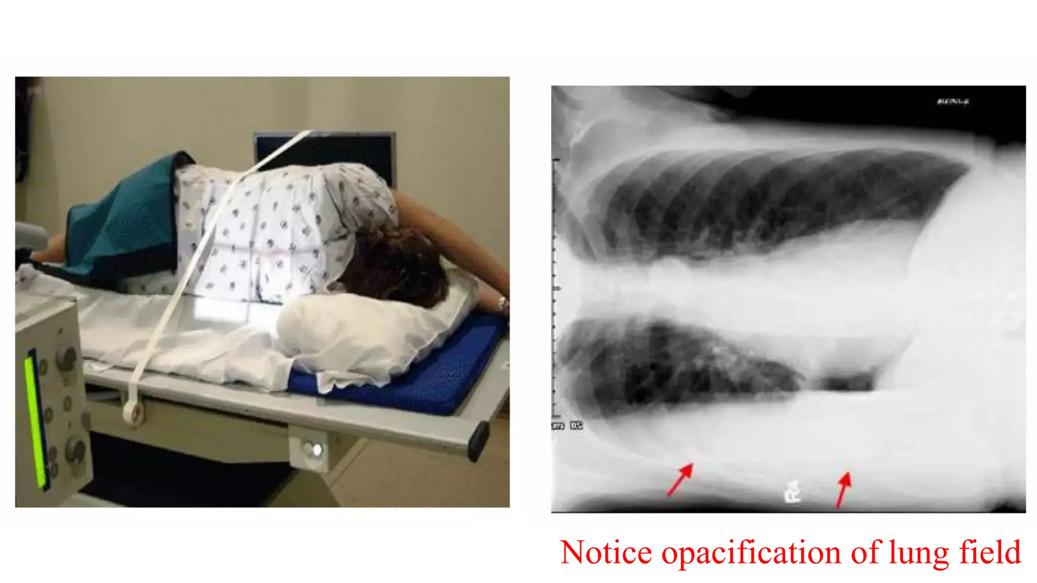 Chest X-Ray (CXR) Interpretation Made Easy: A Comprehensive Guide to ...