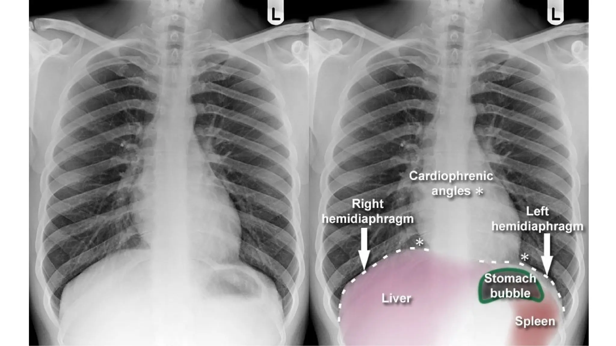 Chest X-Ray (CXR) Interpretation Made Easy: A Comprehensive Guide to Common Chest Pathologies | PPTX