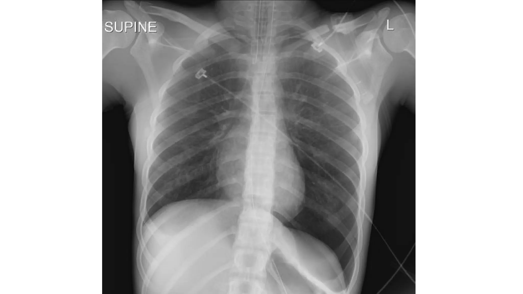 Chest X-Ray (CXR) Interpretation Made Easy: A Comprehensive Guide to ...