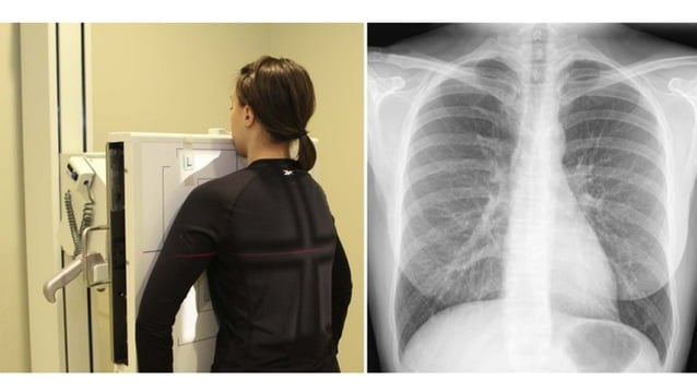Chest X-Ray (CXR) Interpretation Made Easy: A Comprehensive Guide to ...
