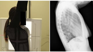 Chest X-Ray (CXR) Interpretation Made Easy: A Comprehensive Guide to ...