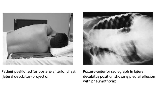 Chest X-Ray (CXR) Interpretation Made Easy: A Comprehensive Guide to ...