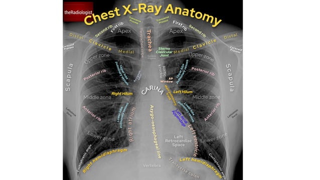 Chest X-Ray (CXR) Interpretation Made Easy: A Comprehensive Guide to ...