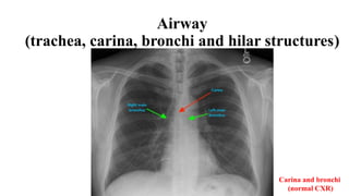 Chest X-Ray (CXR) Interpretation Made Easy: A Comprehensive Guide to ...