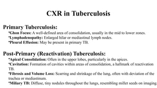 Chest X-Ray (CXR) Interpretation Made Easy: A Comprehensive Guide to ...