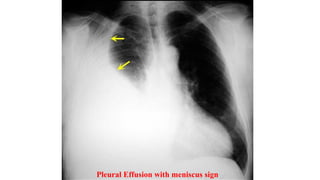 Chest X-Ray (CXR) Interpretation Made Easy: A Comprehensive Guide to ...