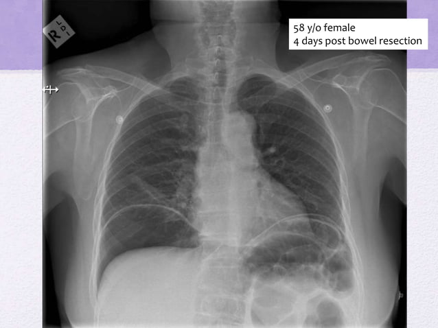 Cxr Interpretation Ppt