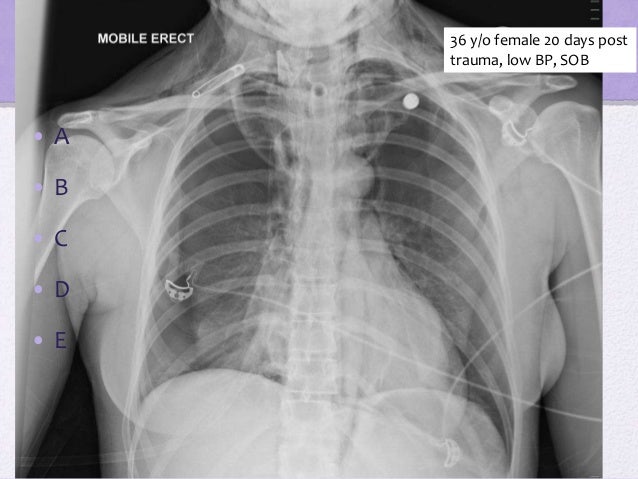 Cxr interpretation