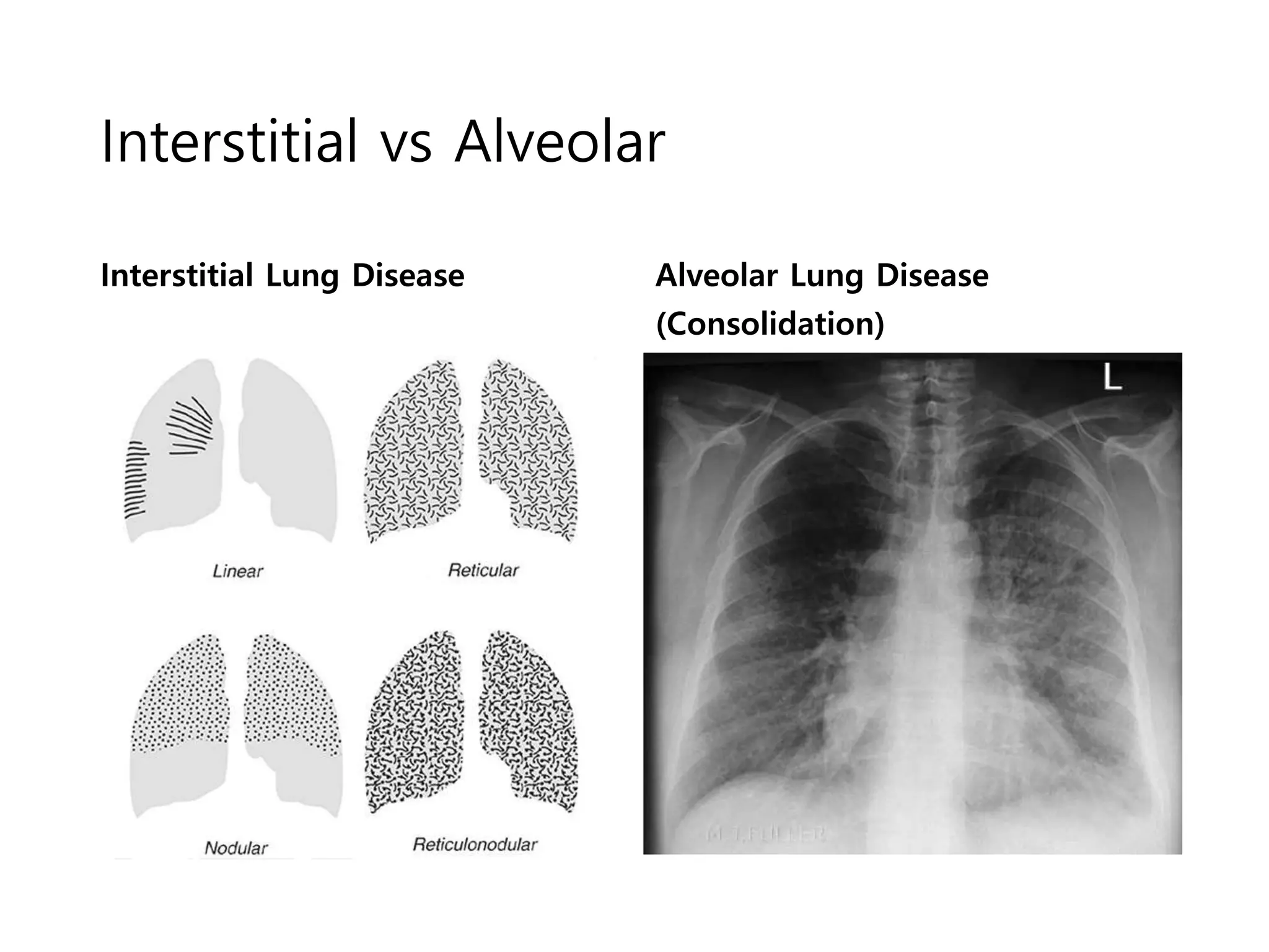 Chest X-ray interpretation (2017) | PPTX