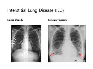 Chest X-ray interpretation (2017) | PPTX