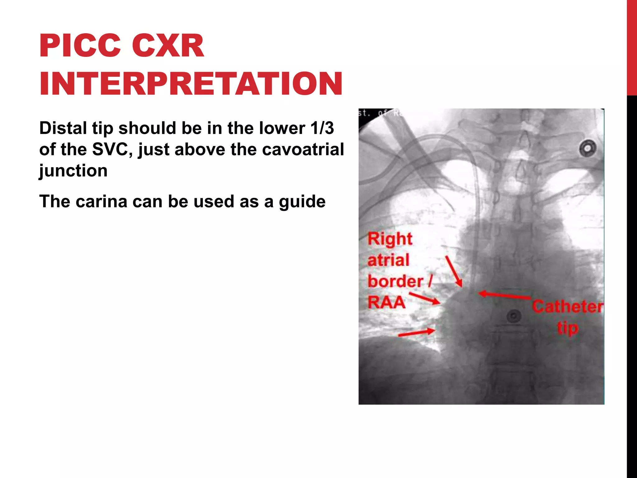 Cxr interpretation | PPTX