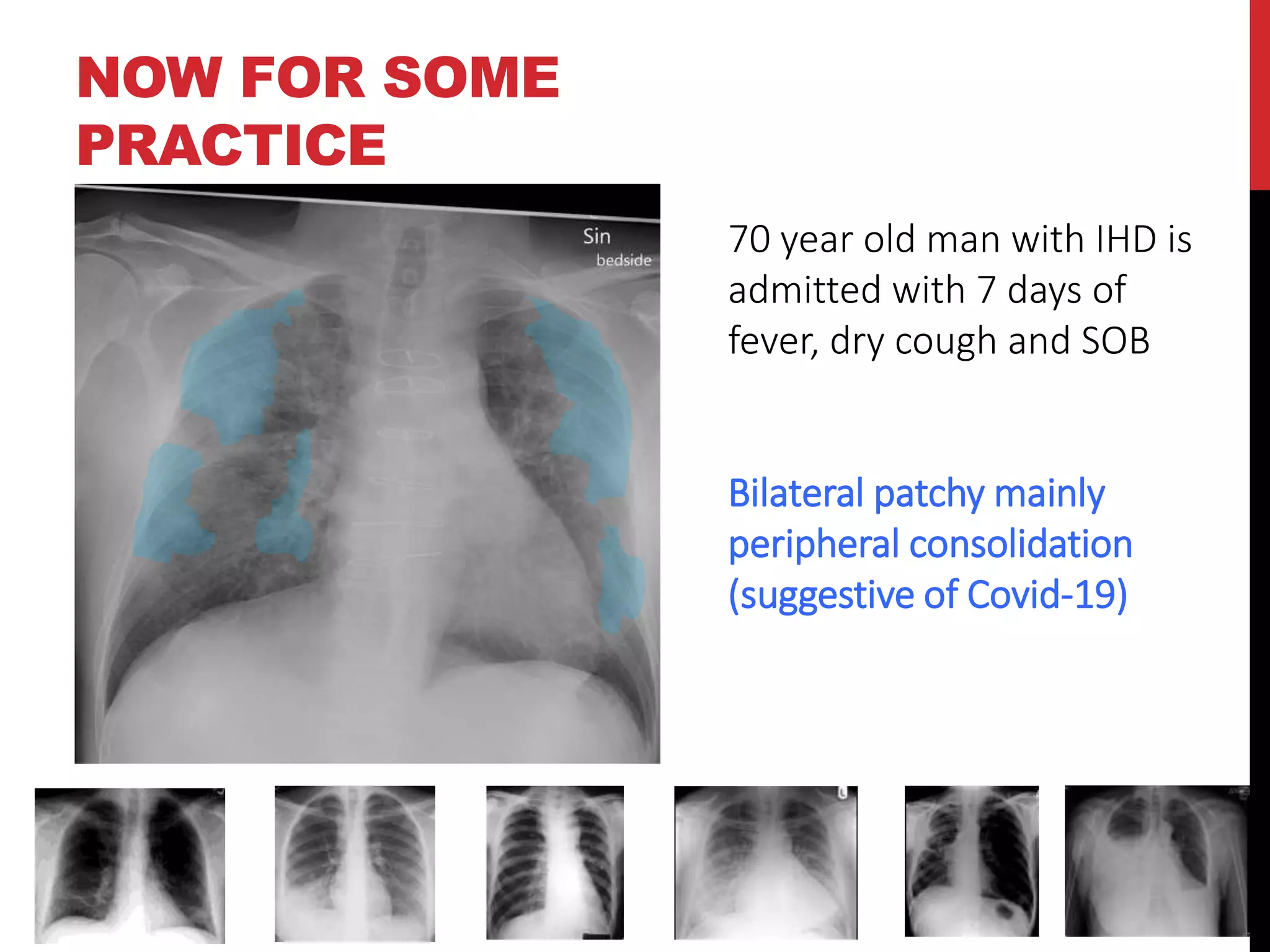 Cxr interpretation | PPTX