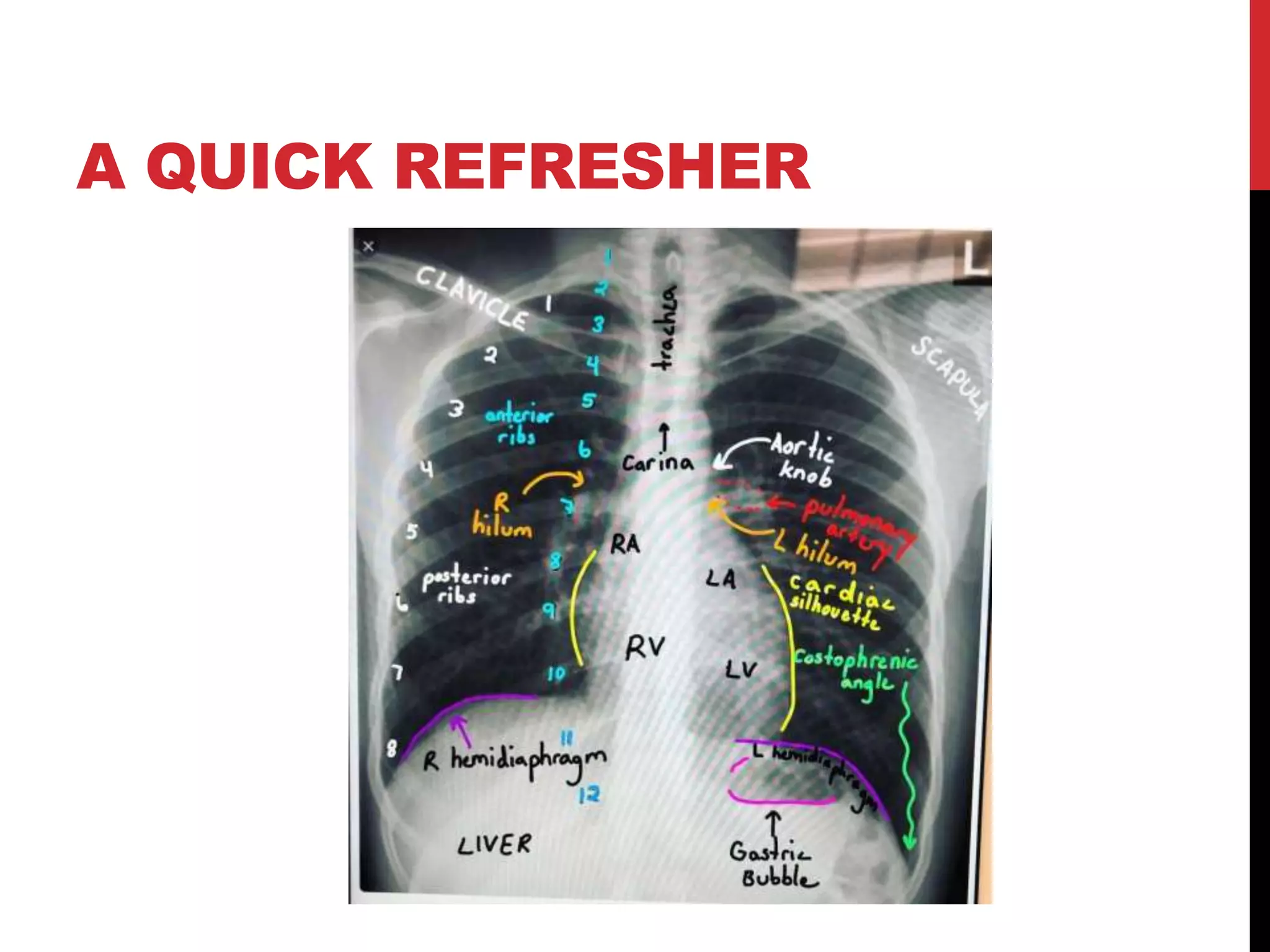 Cxr interpretation | PPTX