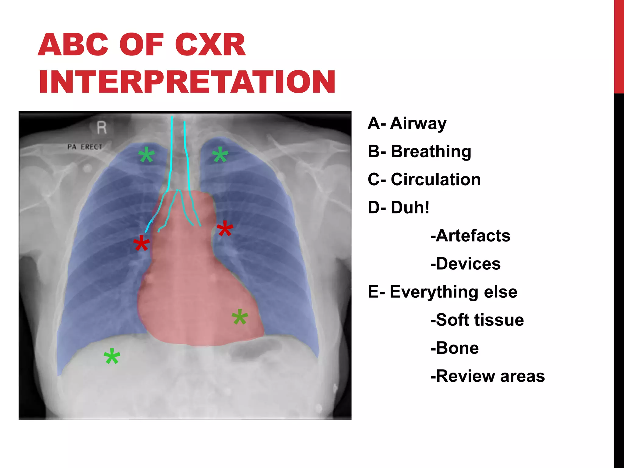 Cxr interpretation | PPTX