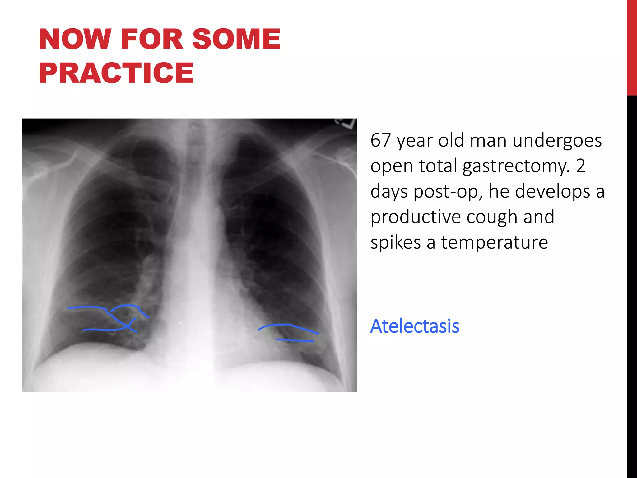 Cxr interpretation | PPTX