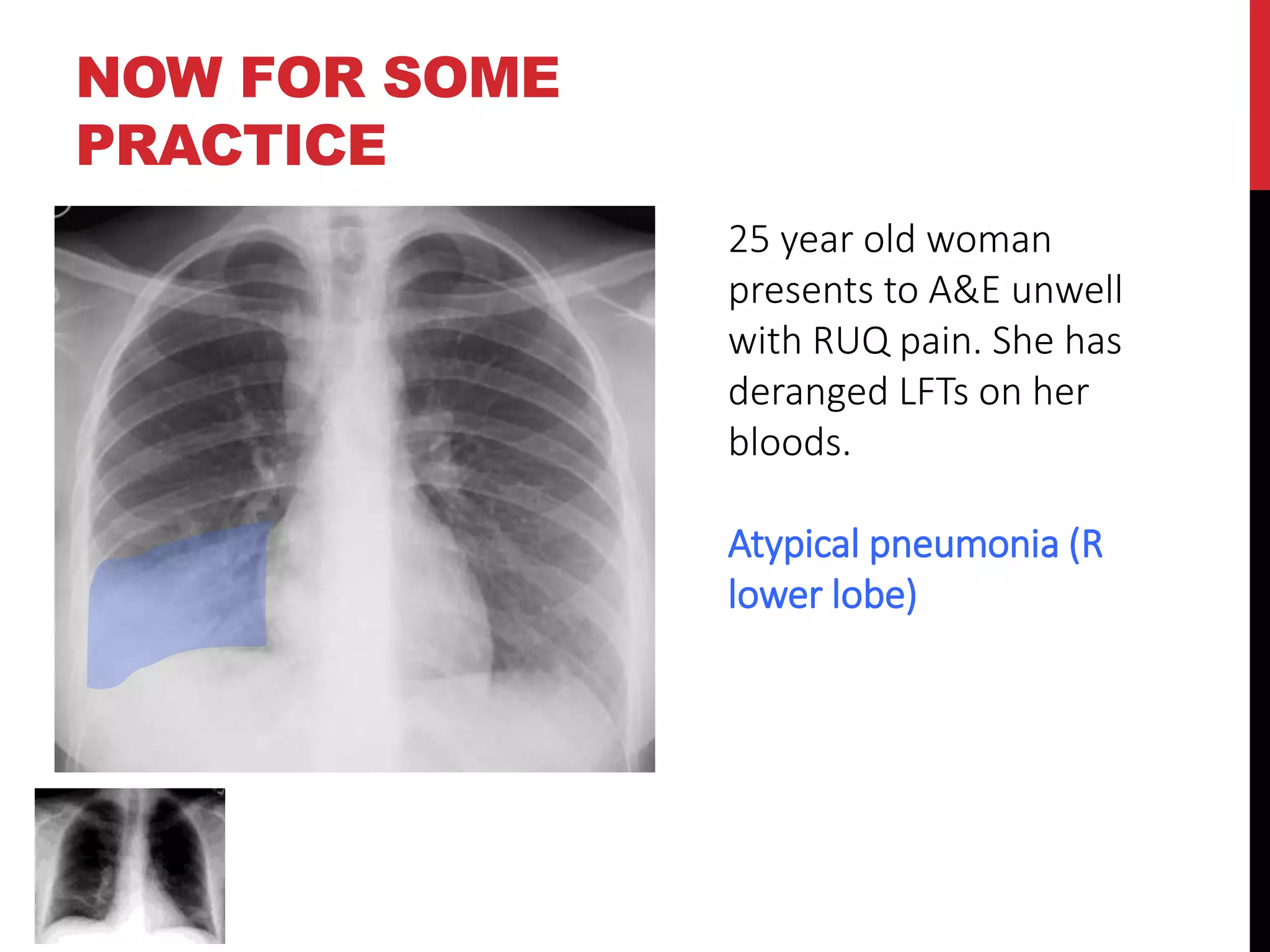 Cxr interpretation | PPTX