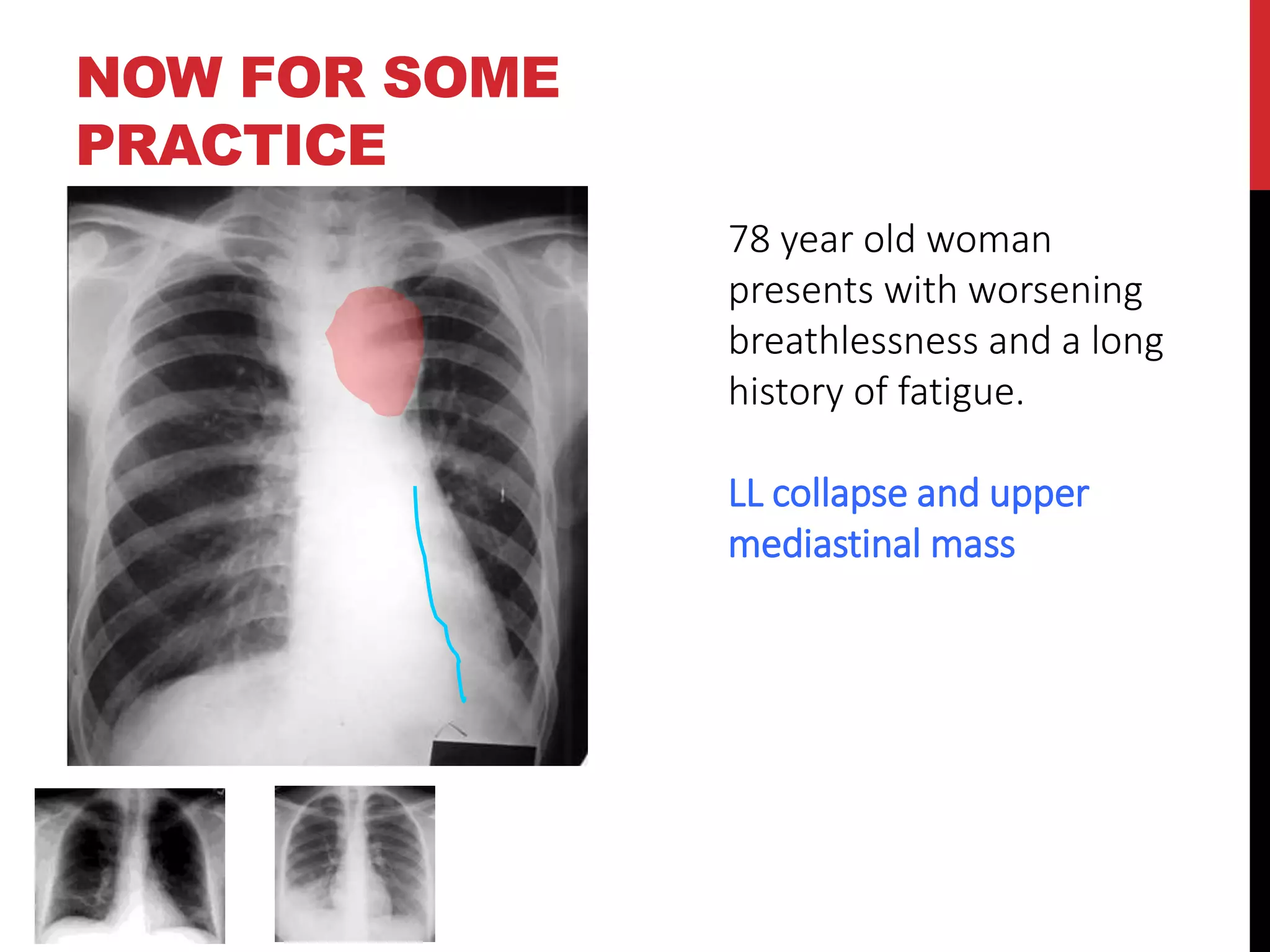 Cxr interpretation | PPTX