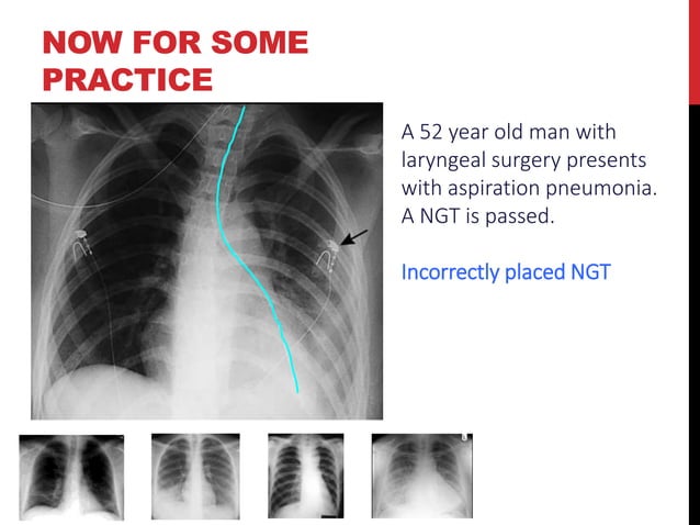 Cxr interpretation | PPTX | Lung and Respiratory Health | Diseases and ...