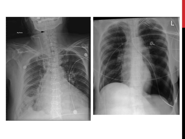 Cxr interpretation | PPTX | Lung and Respiratory Health | Diseases and ...