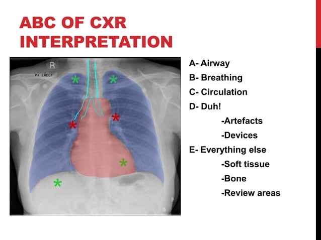 Cxr interpretation | PPTX | Lung and Respiratory Health | Diseases and ...