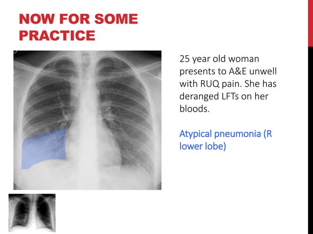 Cxr interpretation | PPTX | Lung and Respiratory Health | Diseases and ...