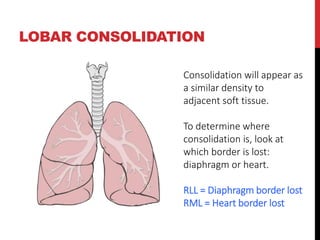 Cxr interpretation | PPTX