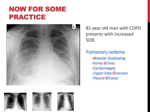 Cxr interpretation | PPTX | Lung and Respiratory Health | Diseases and ...