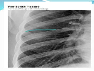 cxr interpretation for medical students.pdf