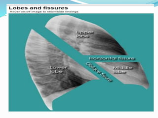 cxr interpretation for medical students.pdf