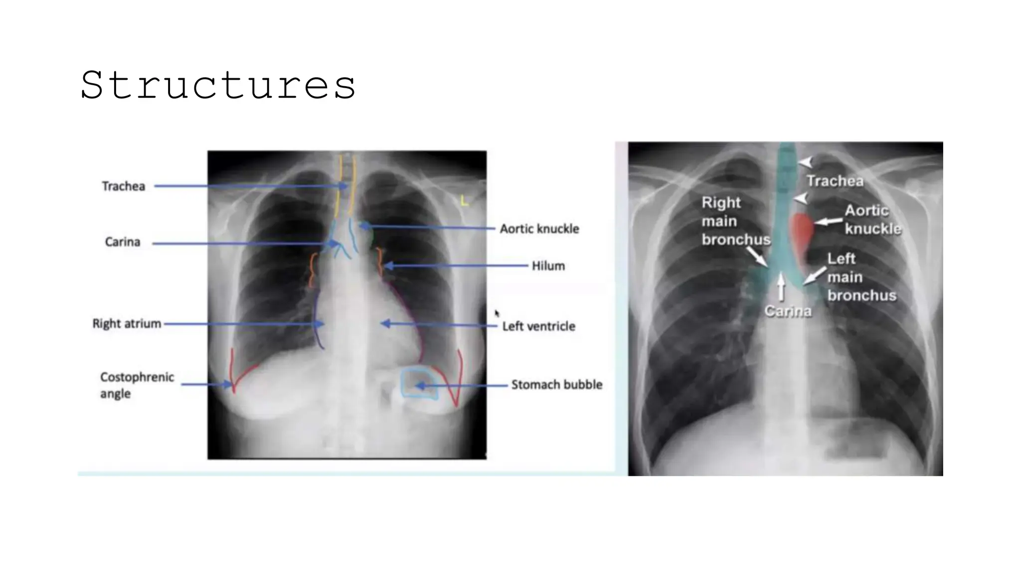 Chest X-ray Interpretation Structure and Tips | PPTX | Lung and ...
