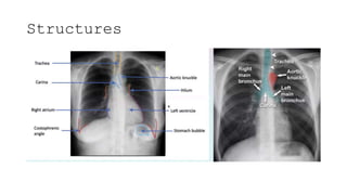 Chest X-ray Interpretation Structure and Tips | PPTX | Lung and ...