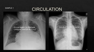 CHEST XRAY INTERPRETATION FOR ANAESTHETISTS. | PPTX