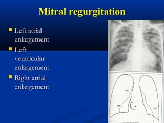 Left Atrial Enlargement X Ray