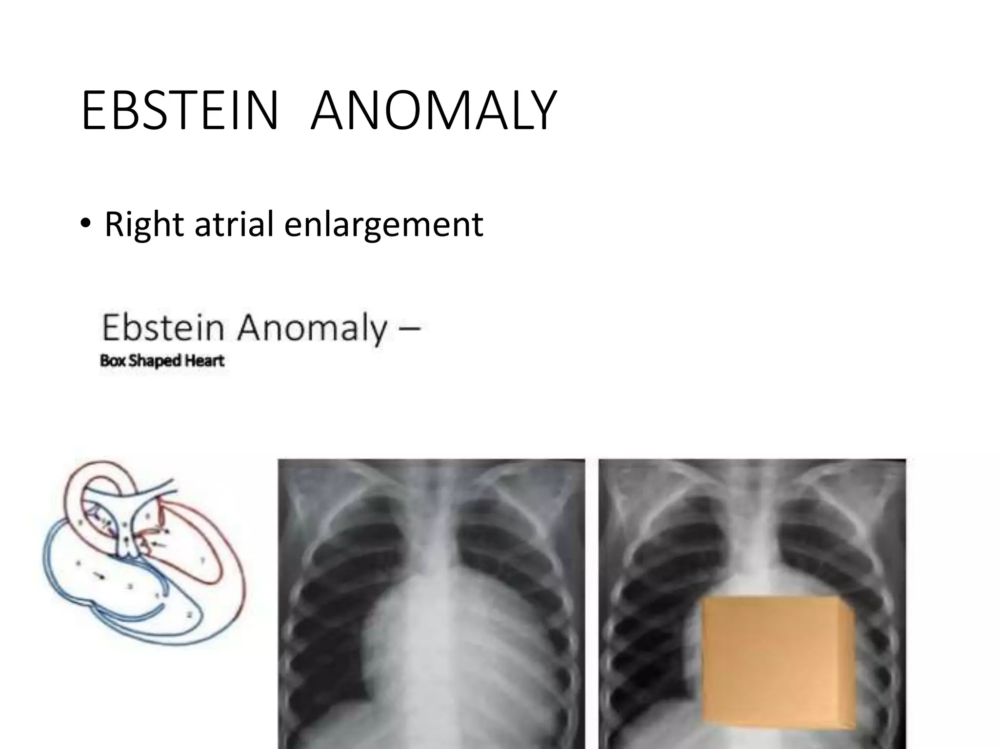 Cxr of common heart pathology agp | PPTX