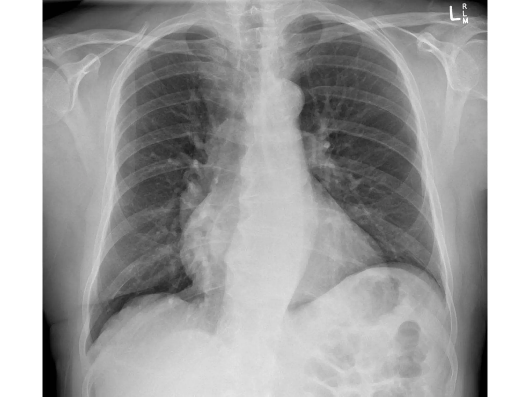 Cxr of common heart pathology agp | PPTX