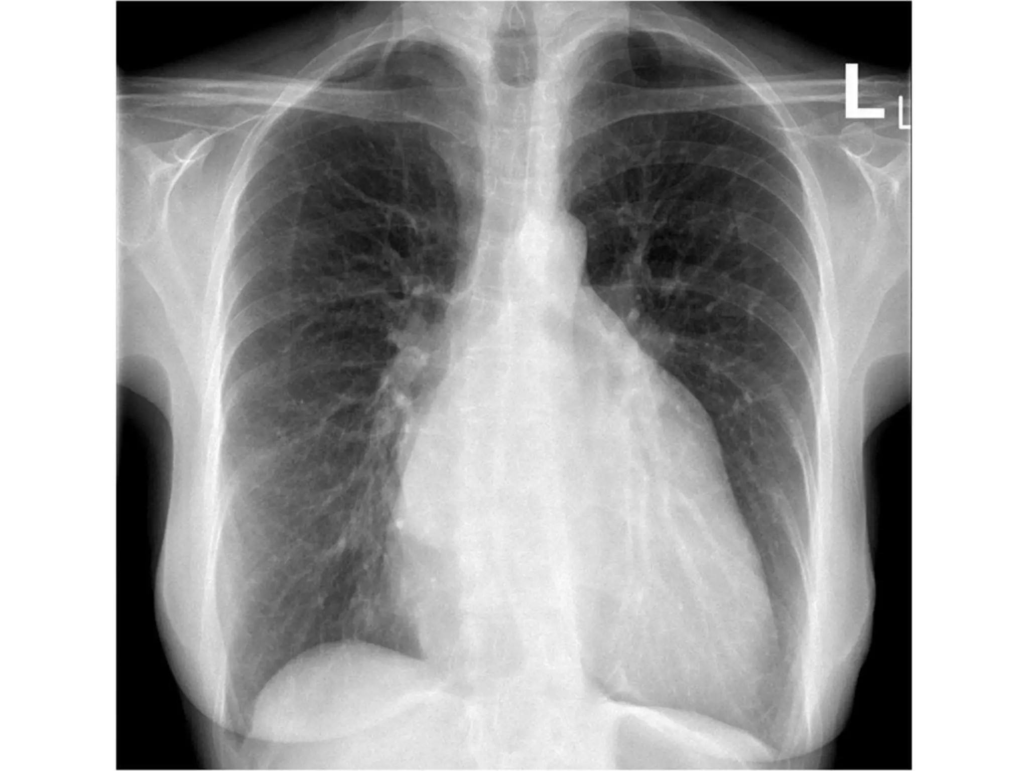 Cxr of common heart pathology agp | PPTX