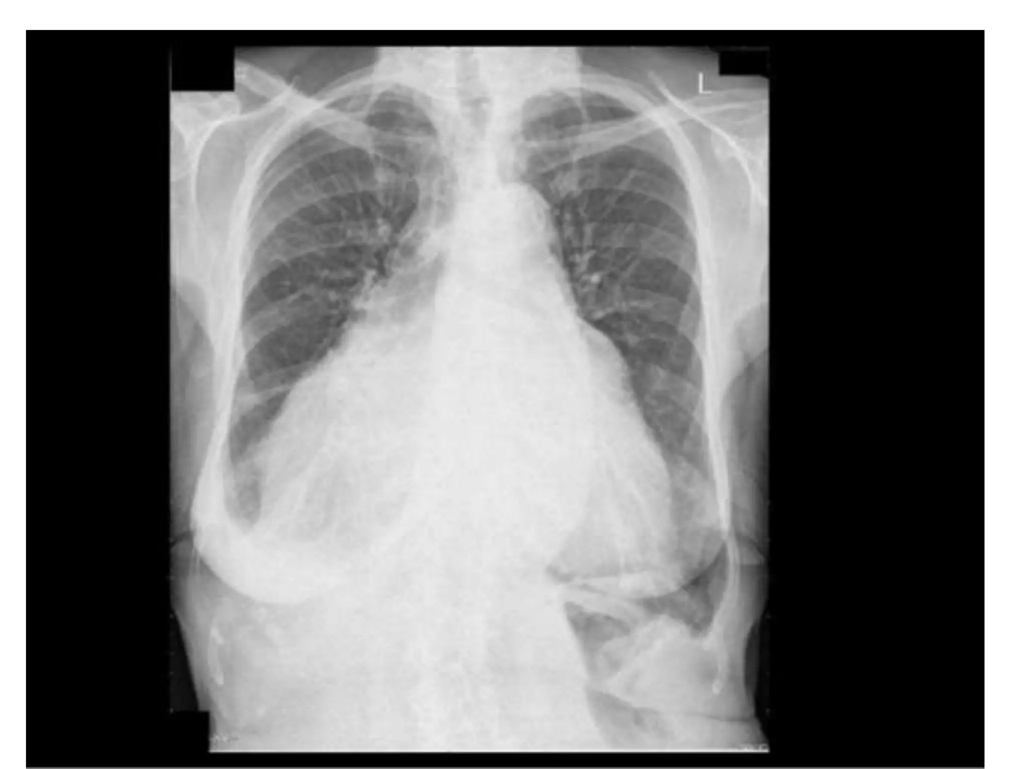 Cxr of common heart pathology agp | PPTX