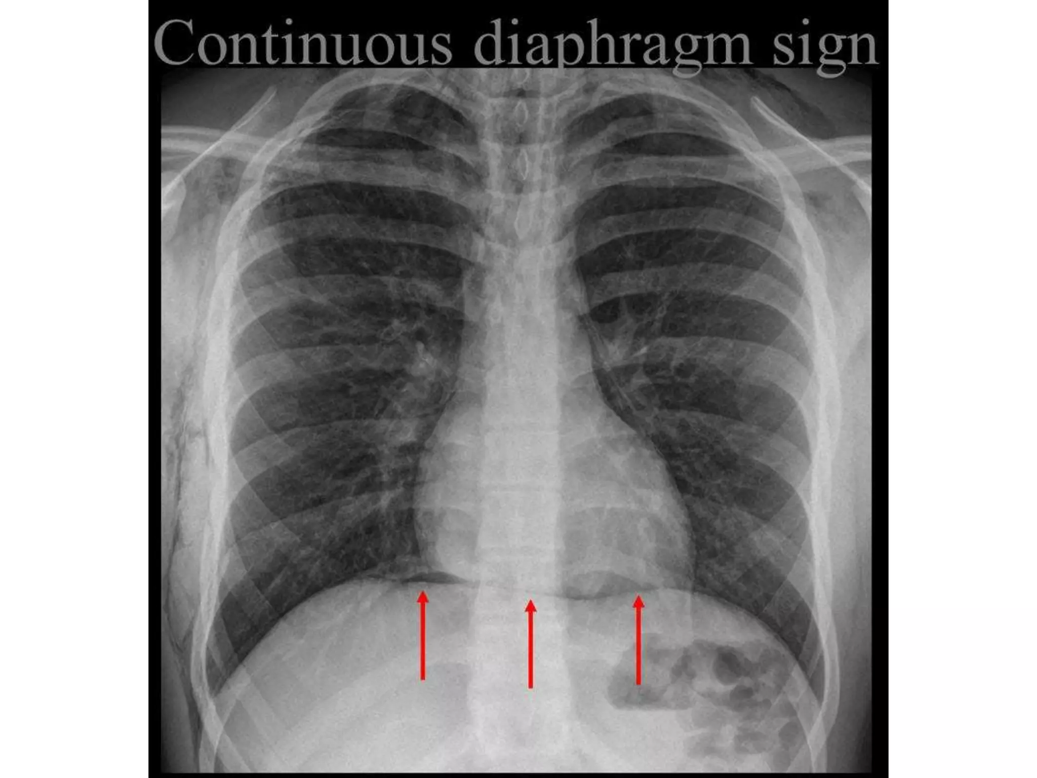 Cxr of common heart pathology agp | PPTX