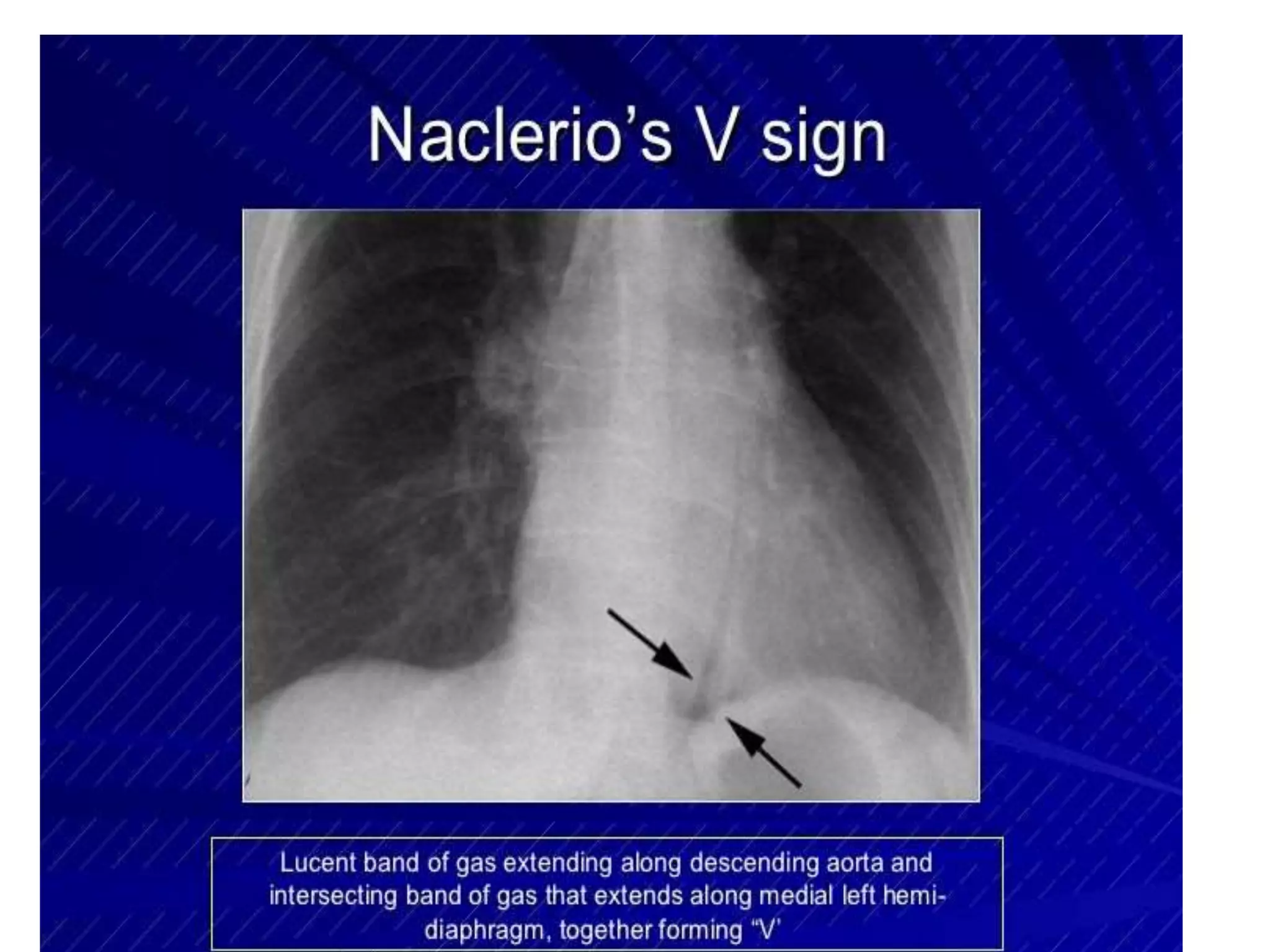 Cxr of common heart pathology agp | PPTX