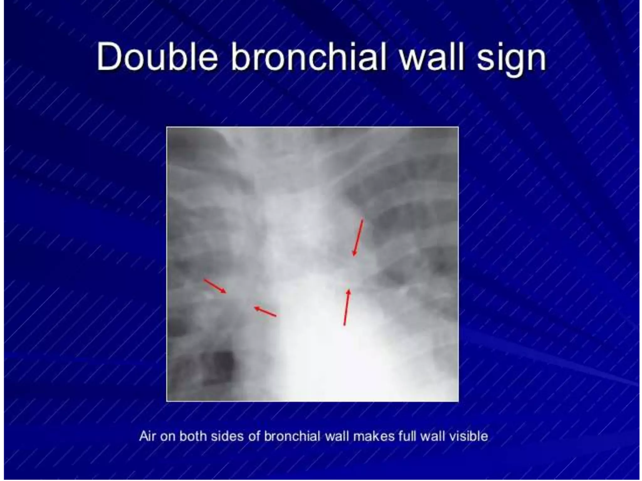 Cxr of common heart pathology agp | PPTX