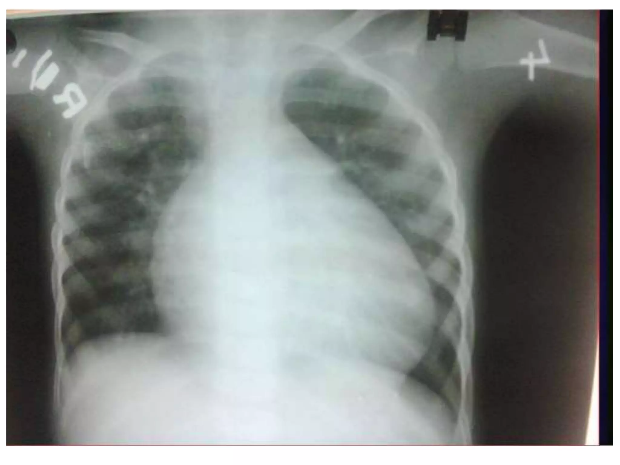 Cxr of common heart pathology agp | PPTX