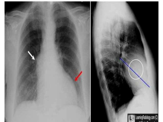 Cxr of common heart pathology agp | PPTX
