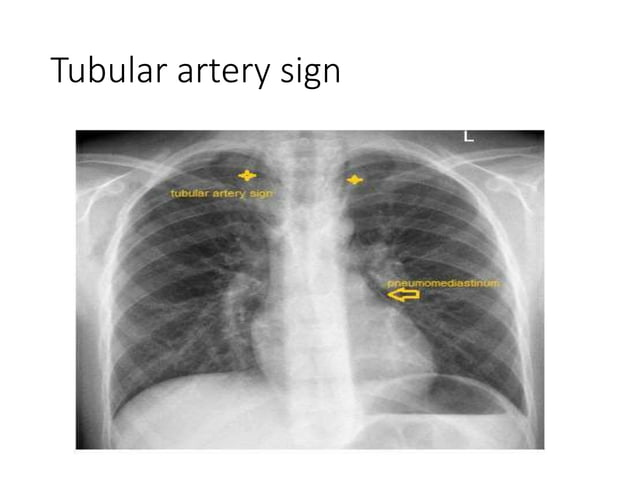 Cxr of common heart pathology agp | PPTX
