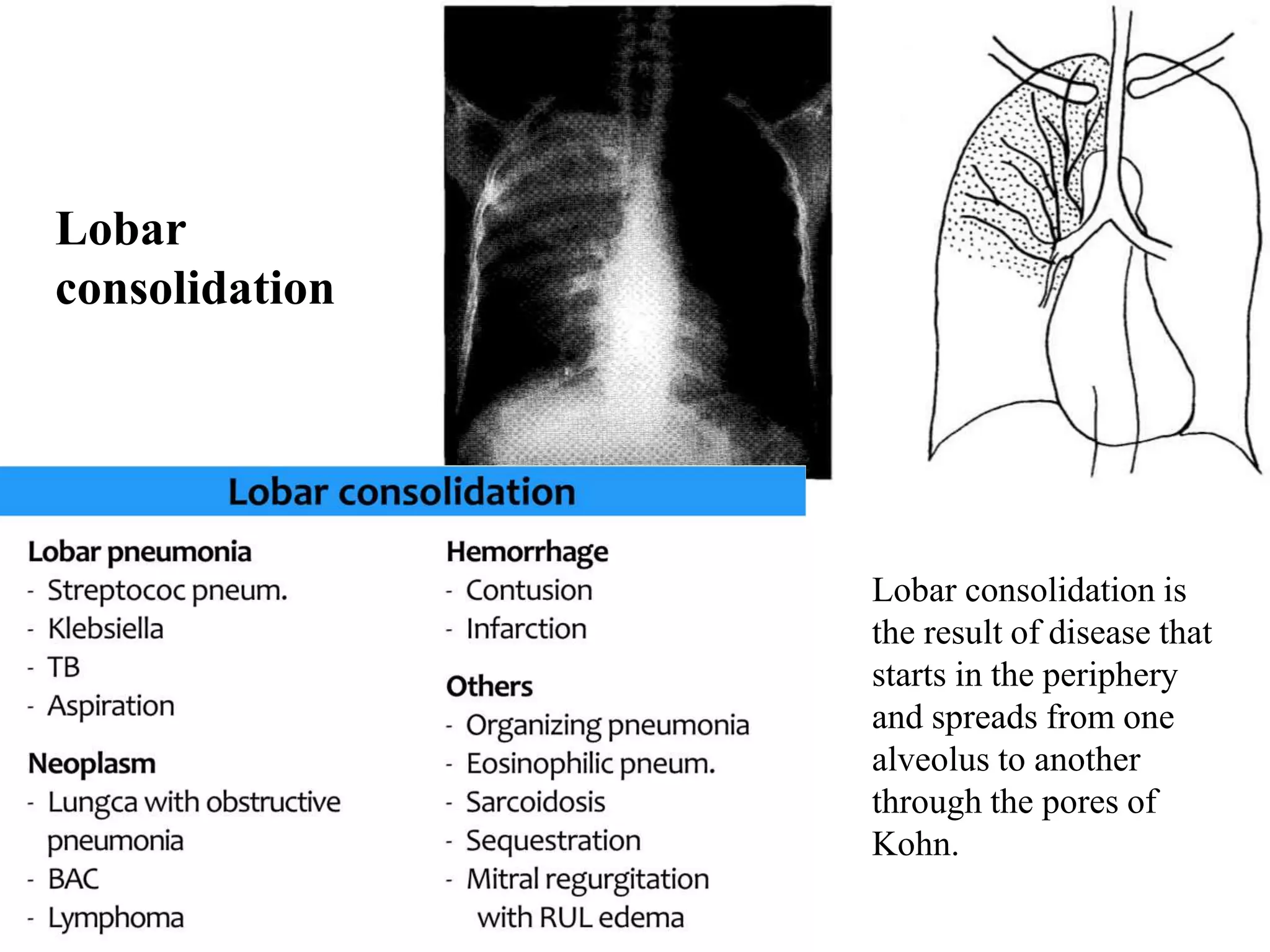 Chest X-ray patterns | PPTX