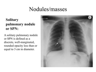Chest X-ray patterns | PPTX