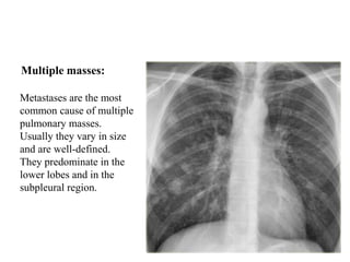 Chest X-ray patterns | PPTX