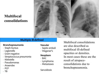 Chest X-ray patterns | PPTX
